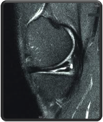 MRI MENISCUS - Naples Orthopedic Doctor | Leon Mead MD